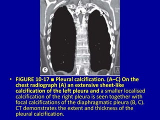 The Chest Wall, Pleura, Diaphragm and Intervention 10 Dr. Muhammad Bin ...