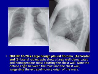 The Chest Wall, Pleura, Diaphragm and Intervention 10 Dr. Muhammad Bin ...