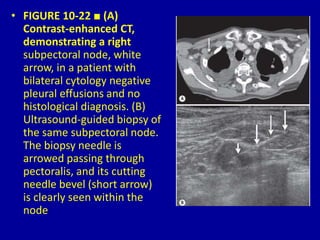 The Chest Wall, Pleura, Diaphragm and Intervention 10 Dr. Muhammad Bin ...