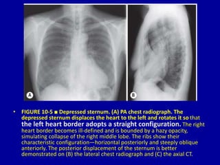 The Chest Wall, Pleura, Diaphragm and Intervention 10 Dr. Muhammad Bin ...