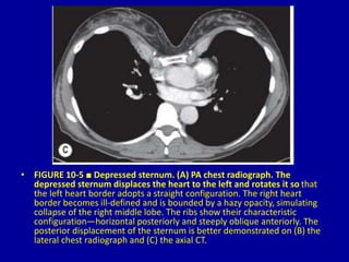 The Chest Wall, Pleura, Diaphragm and Intervention 10 Dr. Muhammad Bin ...