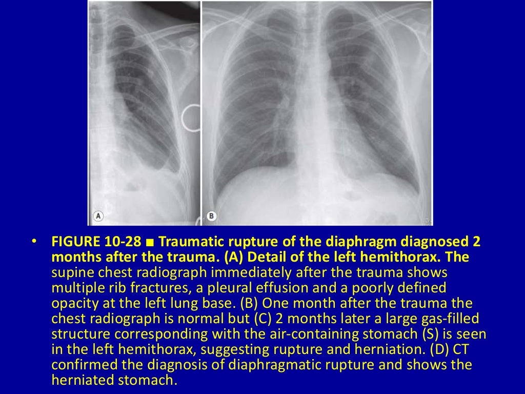 The Chest Wall Pleura Diaphragm And Intervention 10 Dr Muhammad Bi