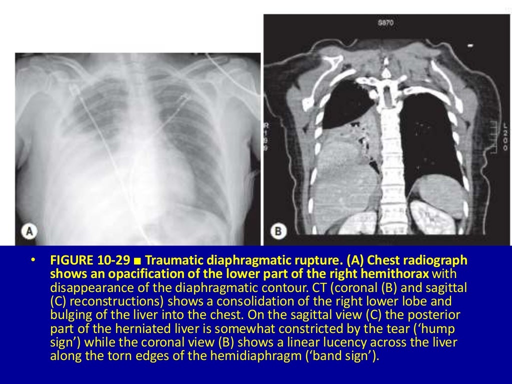 The Chest Wall Pleura Diaphragm And Intervention 10 Dr Muhammad Bi