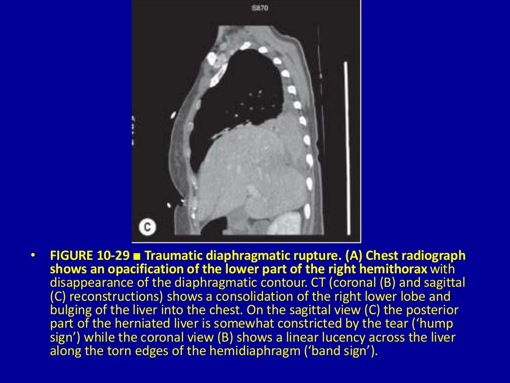 The Chest Wall Pleura Diaphragm And Intervention 10 Dr Muhammad Bi