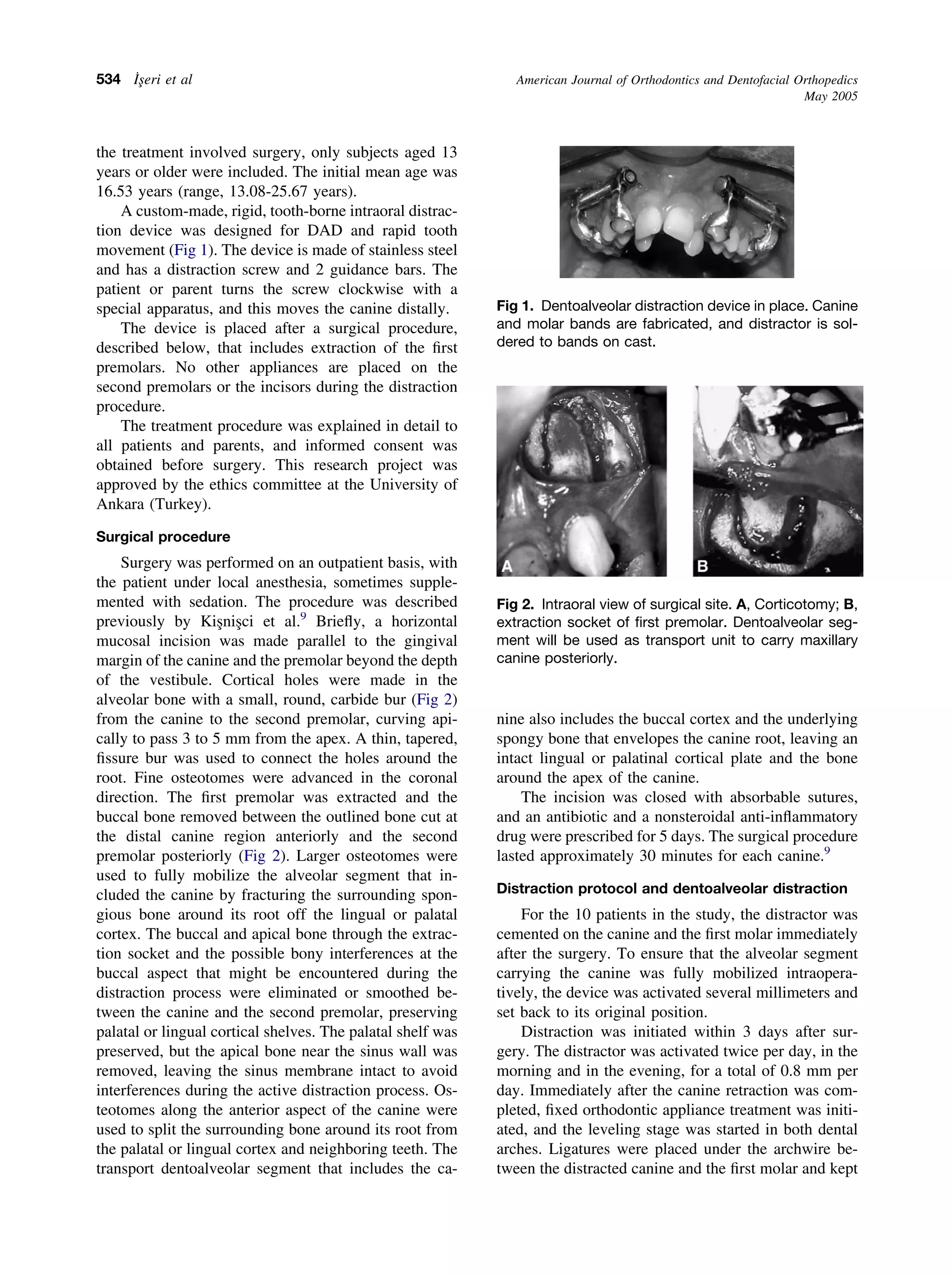 Rapid canine retraction and orthodontic treatment with dentoalveolar ...