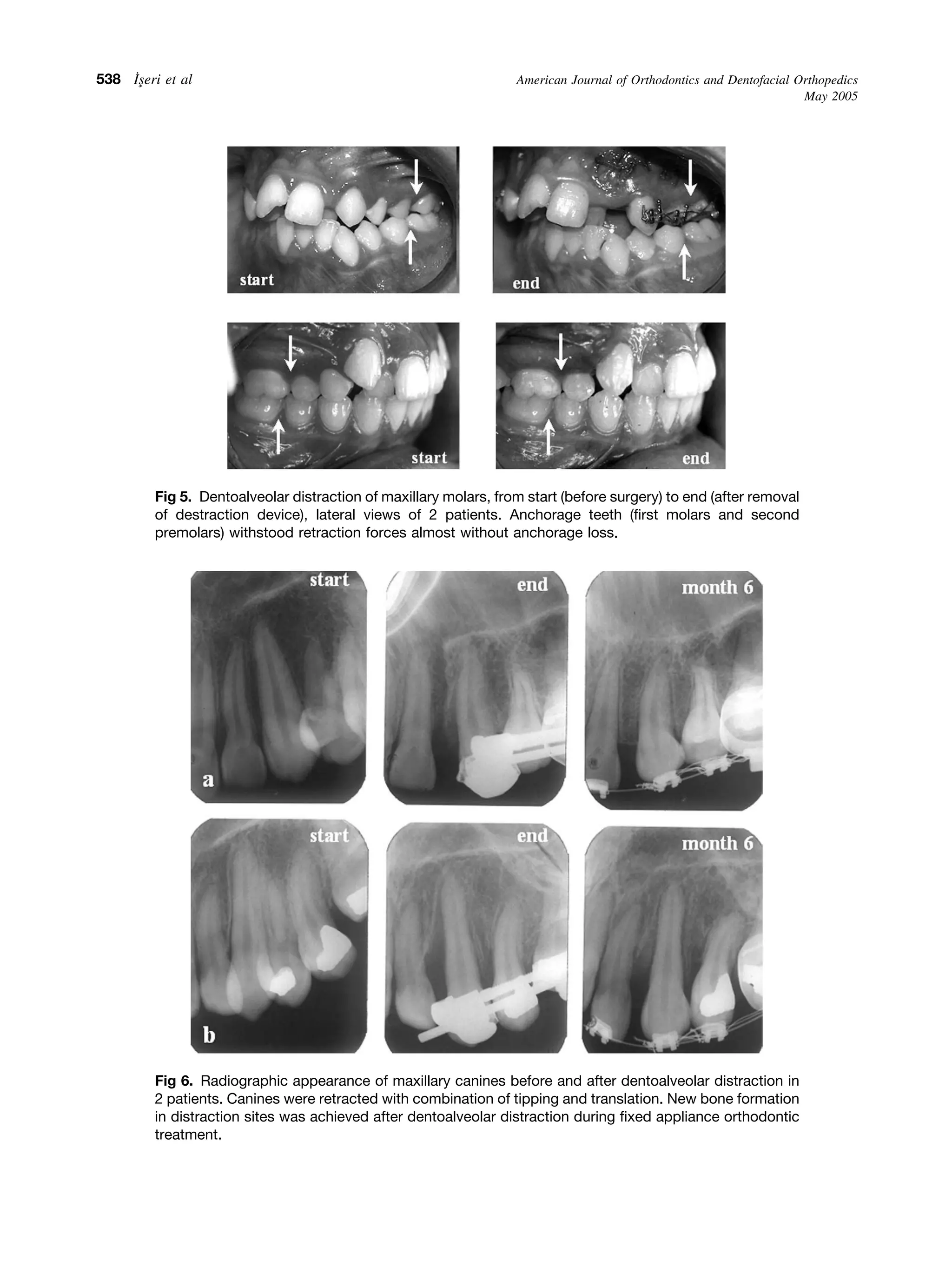 Rapid canine retraction and orthodontic treatment with dentoalveolar ...