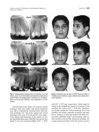 Rapid canine retraction and orthodontic treatment with dentoalveolar ...