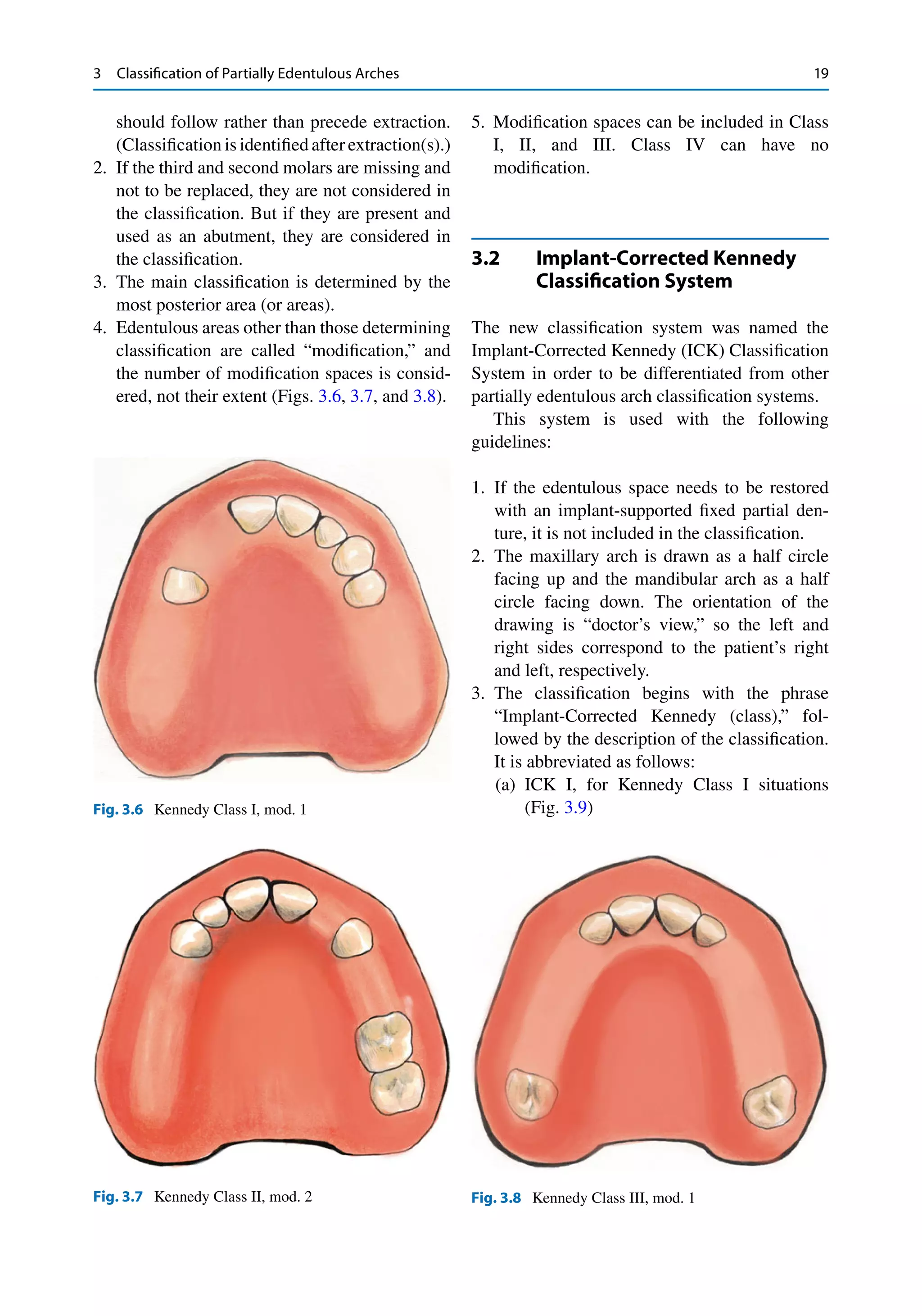 Classification of partially edentulous space | PDF