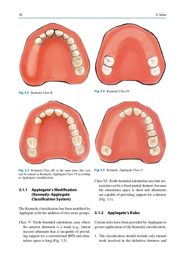 Classification of partially edentulous space