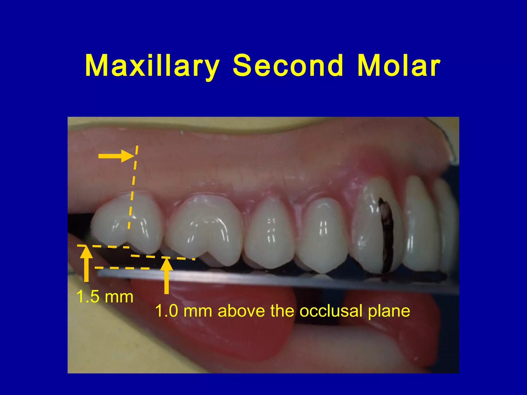 10. posterior teeth arrangement | PPT