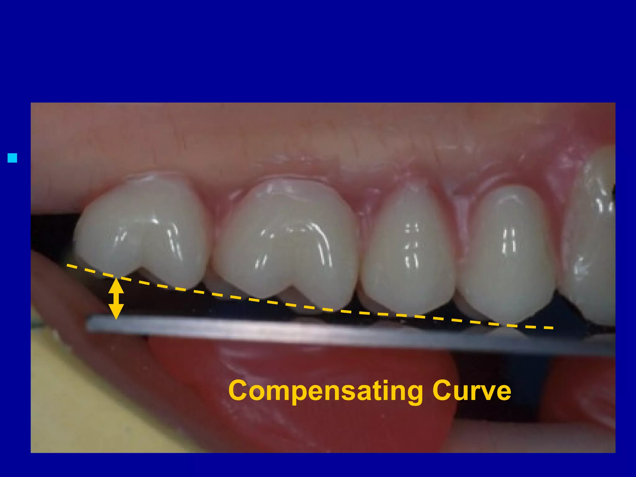 10. posterior teeth arrangement | PPT