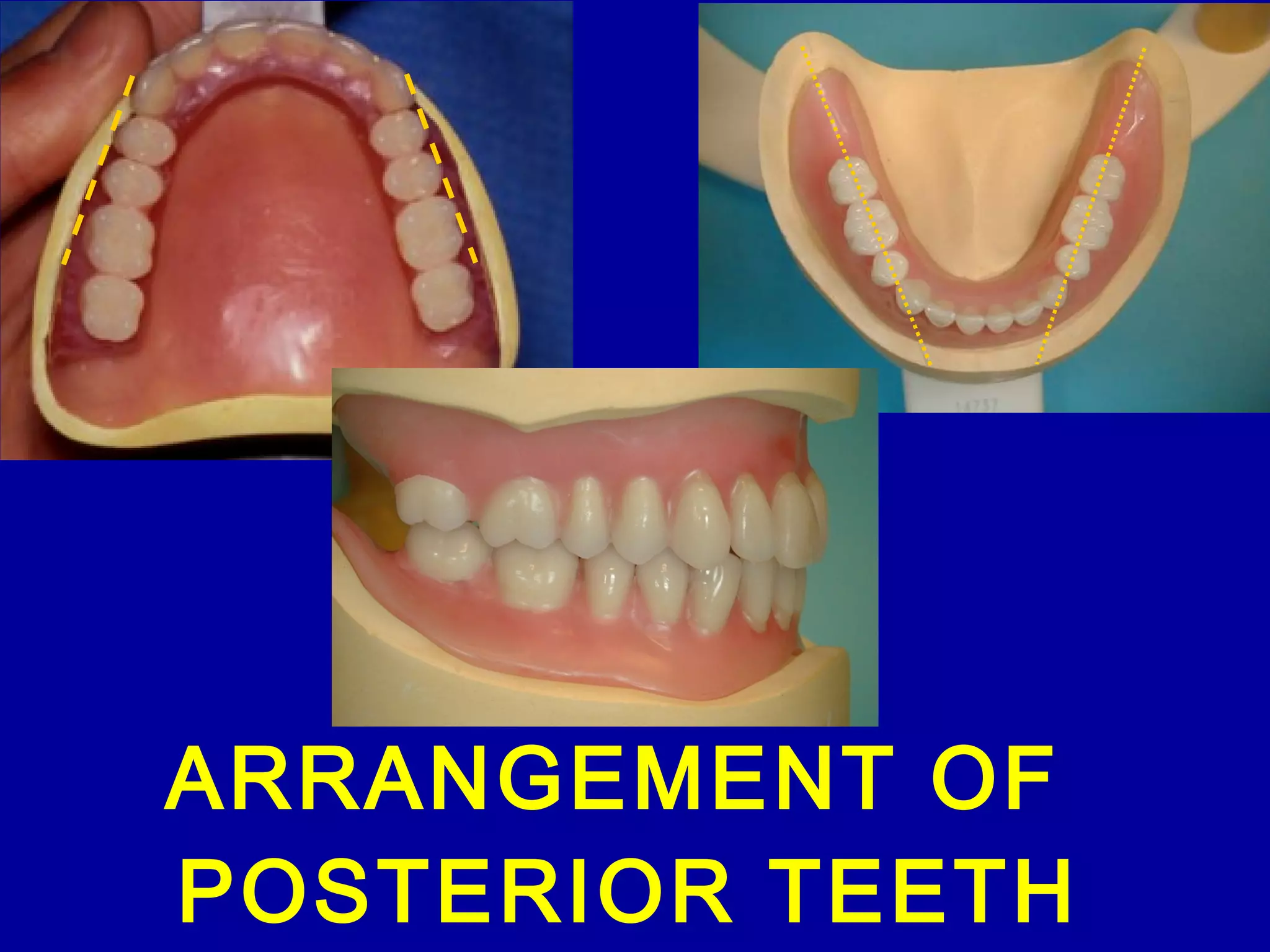 10. posterior teeth arrangement | PPT