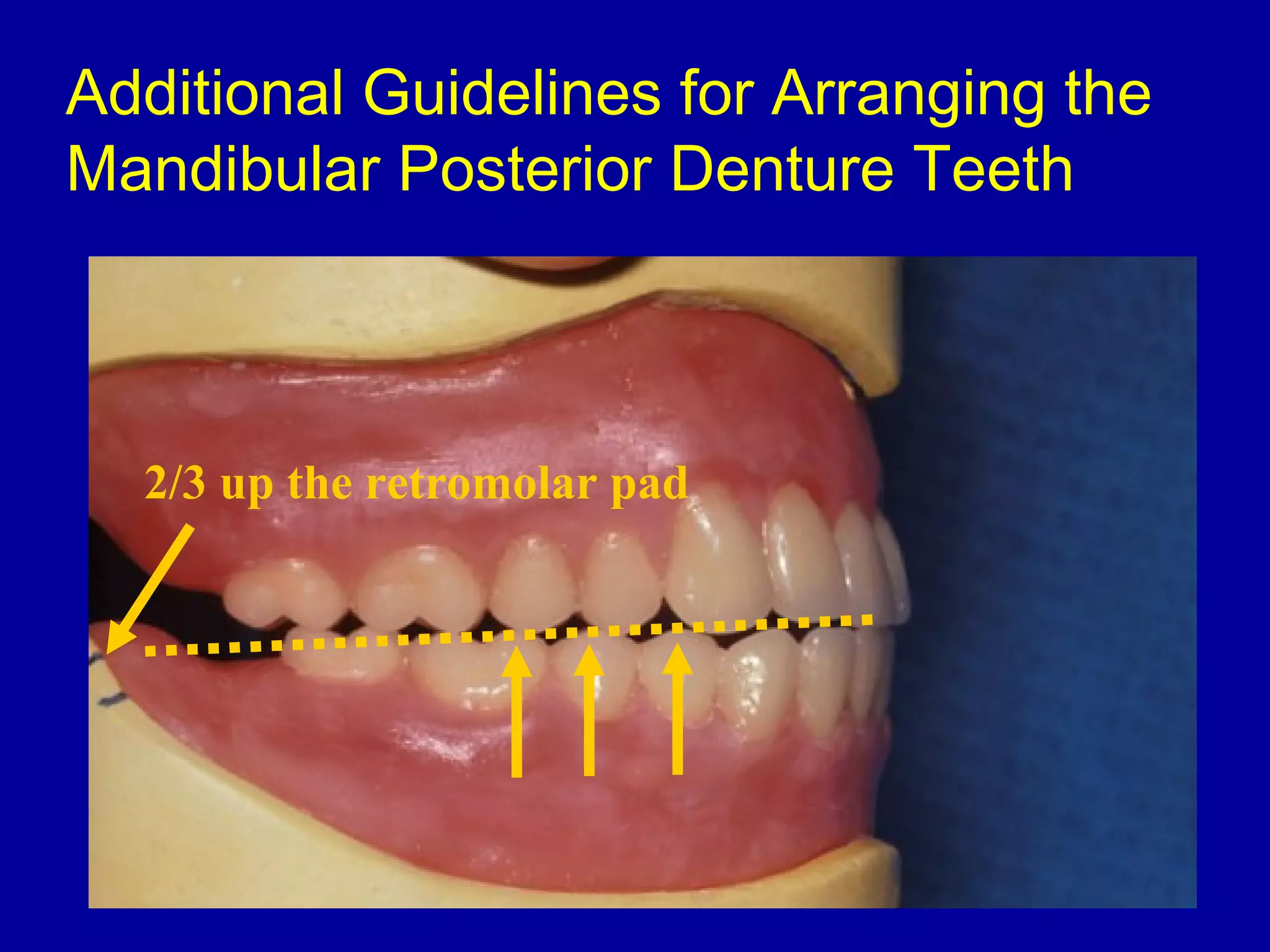 10. posterior teeth arrangement | PPT