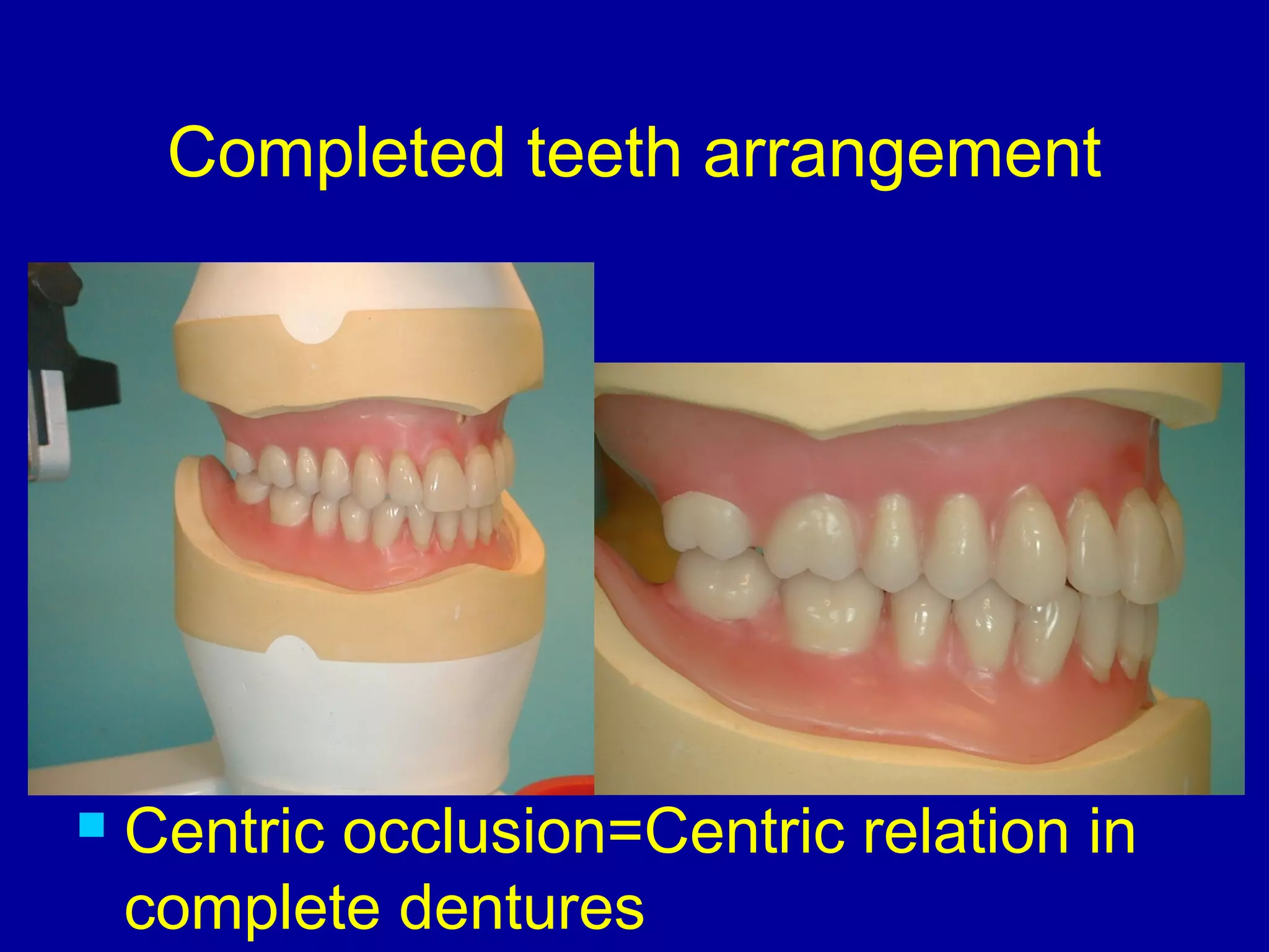 10. posterior teeth arrangement | PPT