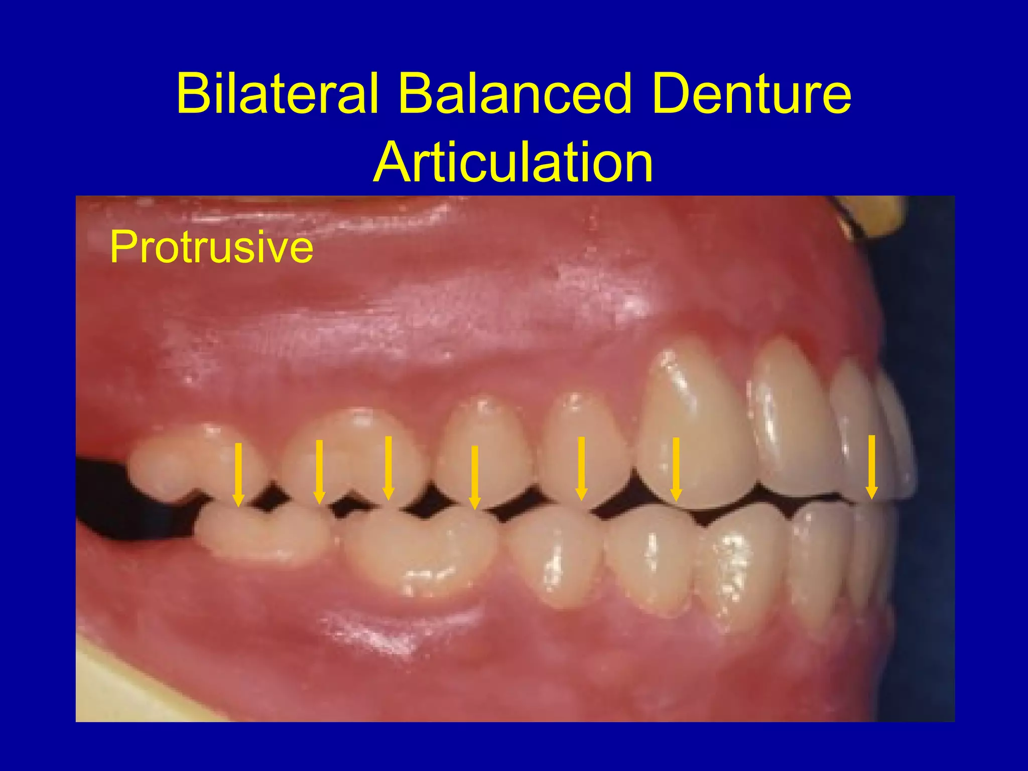10. posterior teeth arrangement | PPT