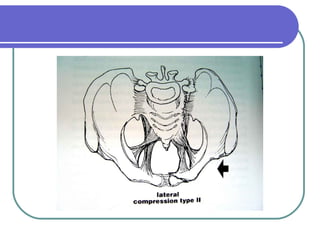 Fractures of Pelvic | PPT