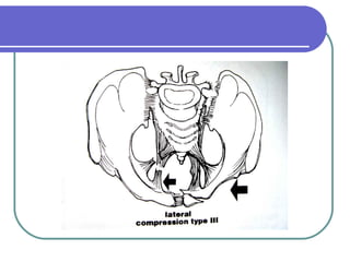 Fractures of Pelvic | PPT