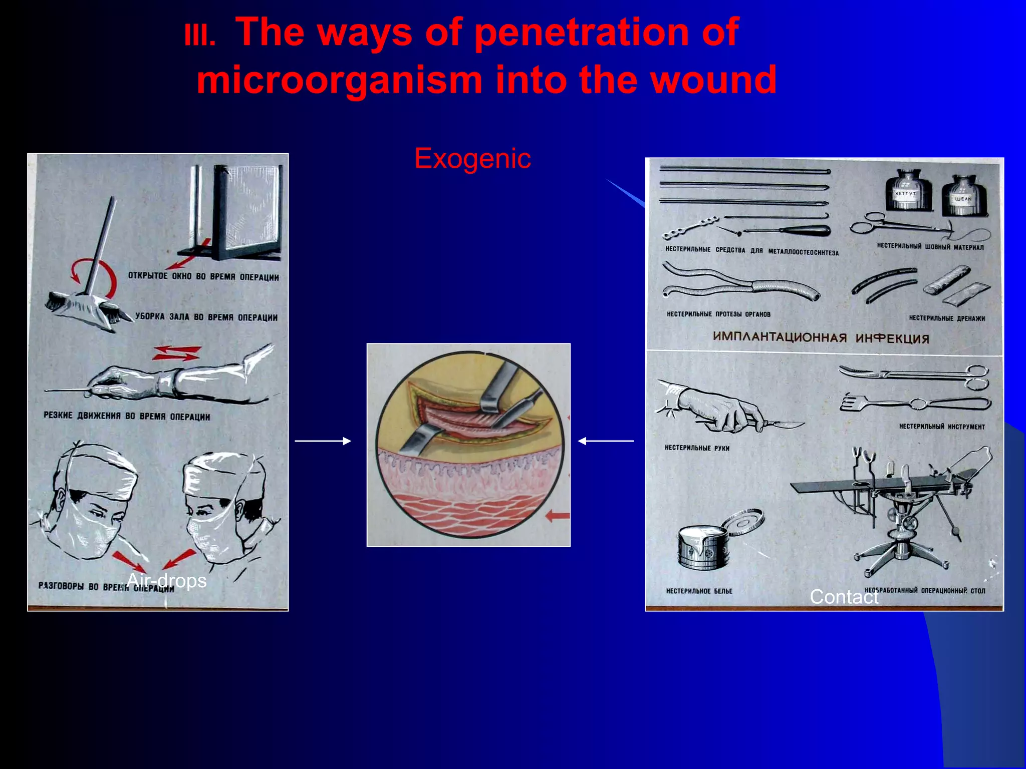 Surgical Infection. Acute purulent infection of skin & cellular spases ...