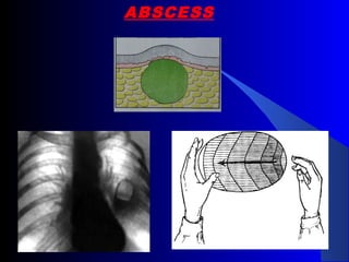 Surgical Infection. Acute purulent infection of skin & cellular spases ...