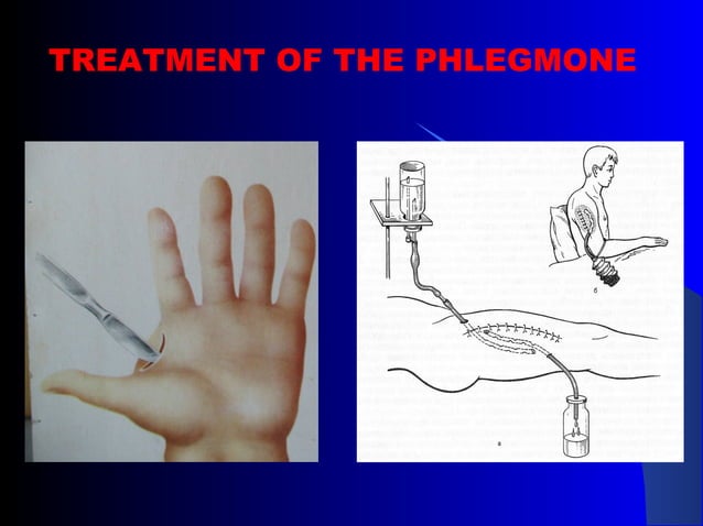 Surgical Infection Acute Purulent Infection Of Skin And Cellular Spases