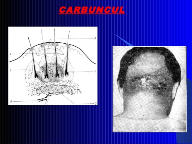 Surgical Infection Acute Purulent Infection Of Skin And Cellular Spases