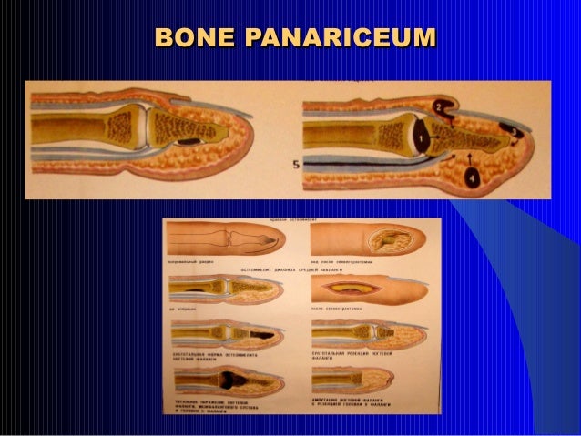 Surgical Infection Acute Purulent Infection Of Skin And Cellular Spases