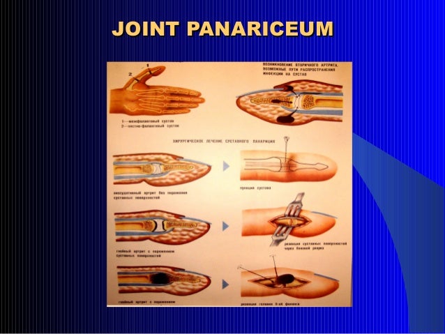 Surgical Infection Acute Purulent Infection Of Skin And Cellular Spases