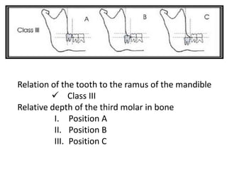 THIRD MOLAR IMPACTION (BASIC) | PPTX