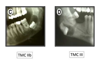 THIRD MOLAR IMPACTION (BASIC) | PPTX