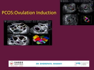 PCOS - Ovulation Induction 1 - Dr Bharati Dhorepatil | PPTX