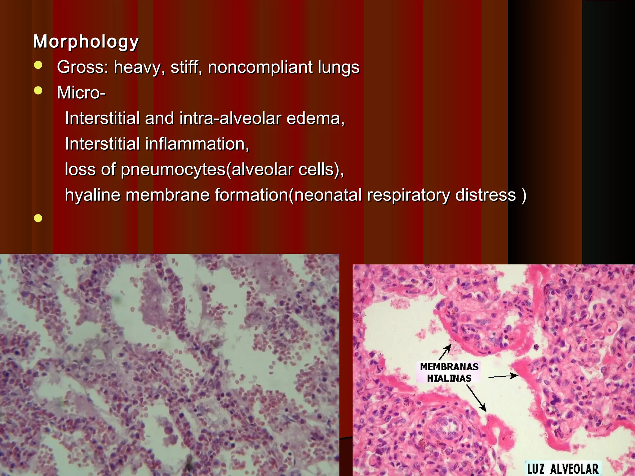 10.RESPIRATORY DISTRESS SYNDROME | PPT