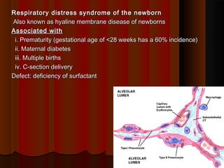 10.RESPIRATORY DISTRESS SYNDROME | PPT