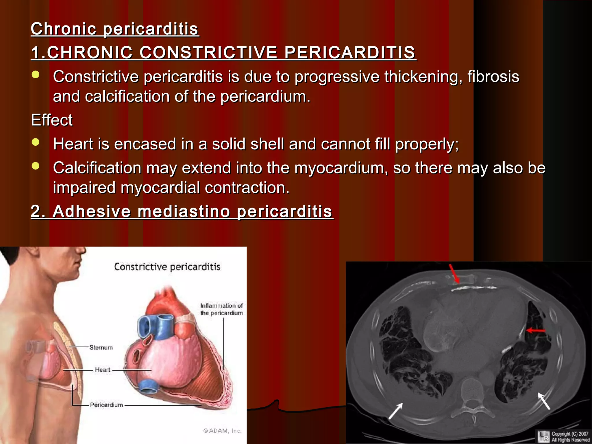 10.Diseases of pericardium | PPT