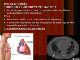 10.Diseases of pericardium | PPT