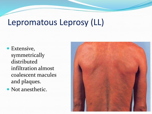 10. Leprosy | PPTX | Skin and Dermatology | Diseases and Conditions