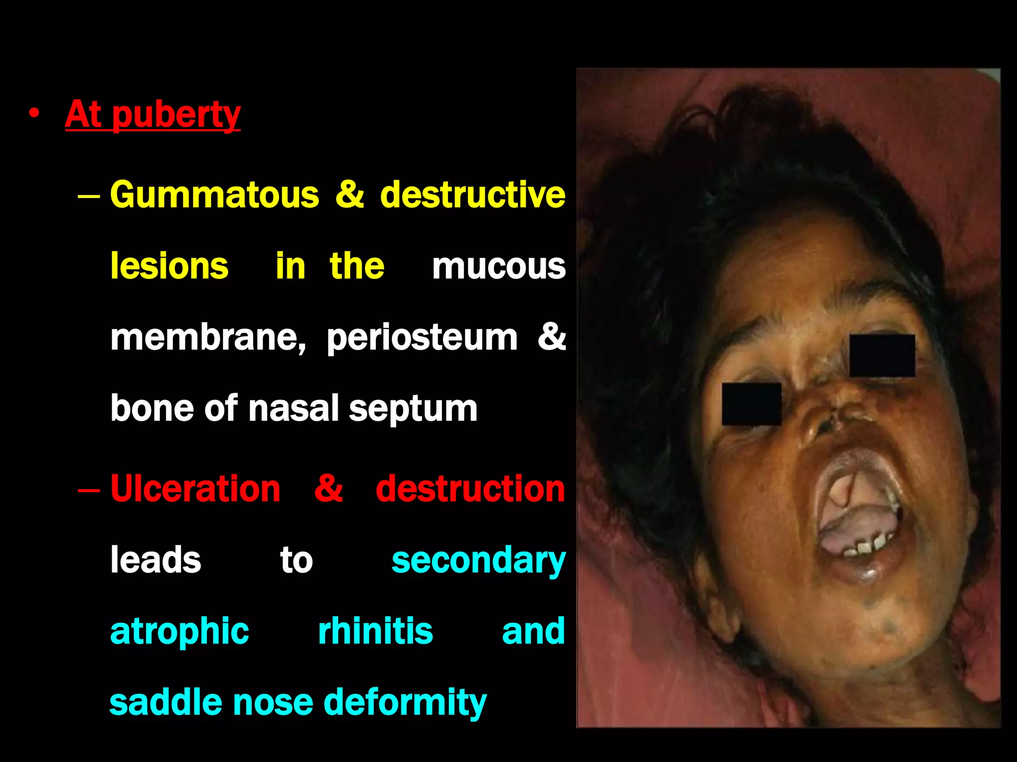 Granulomatous diseases of nose | PPT