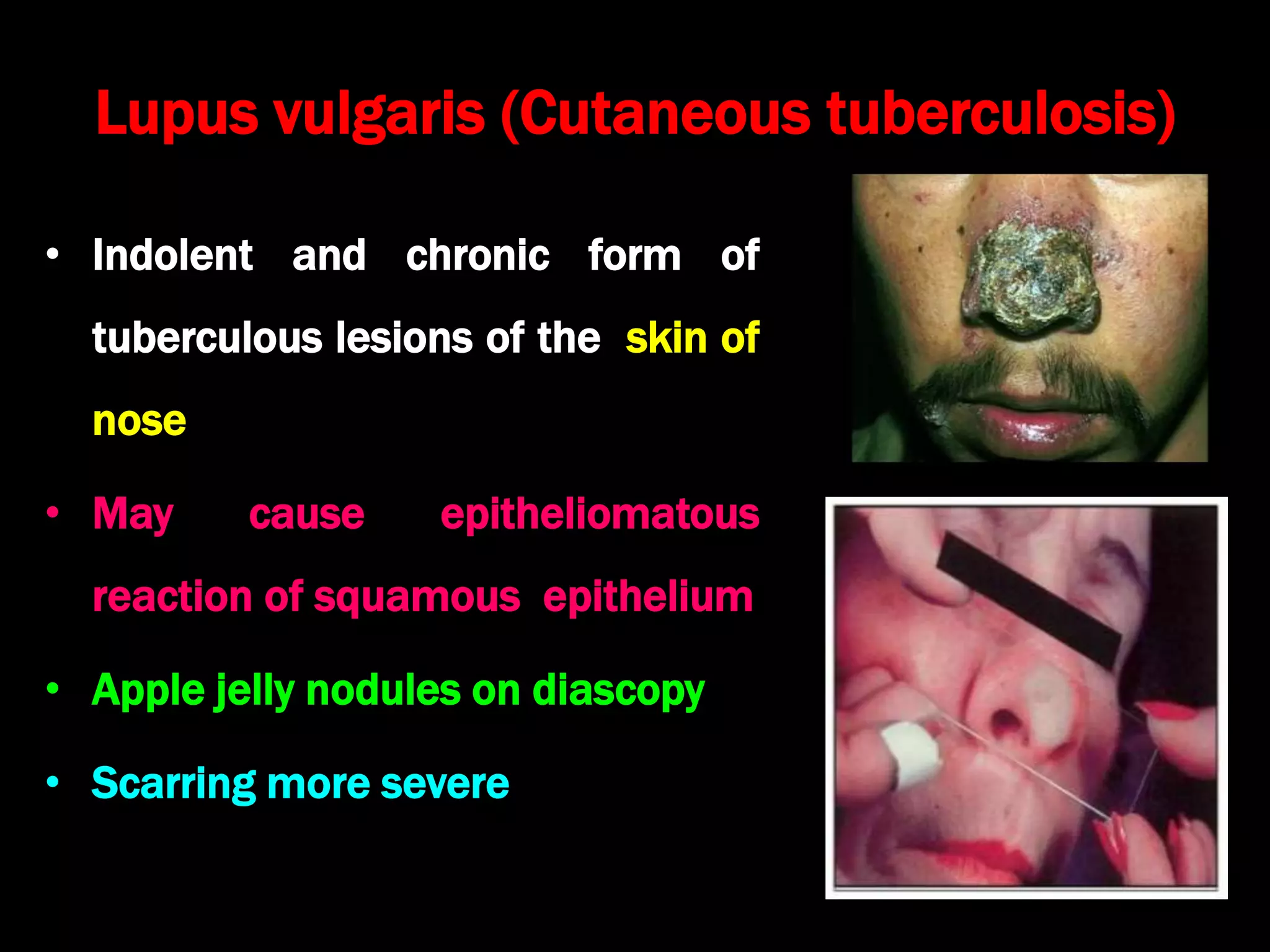 Granulomatous diseases of nose | PPT