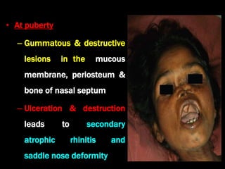 Granulomatous diseases of nose | PPT