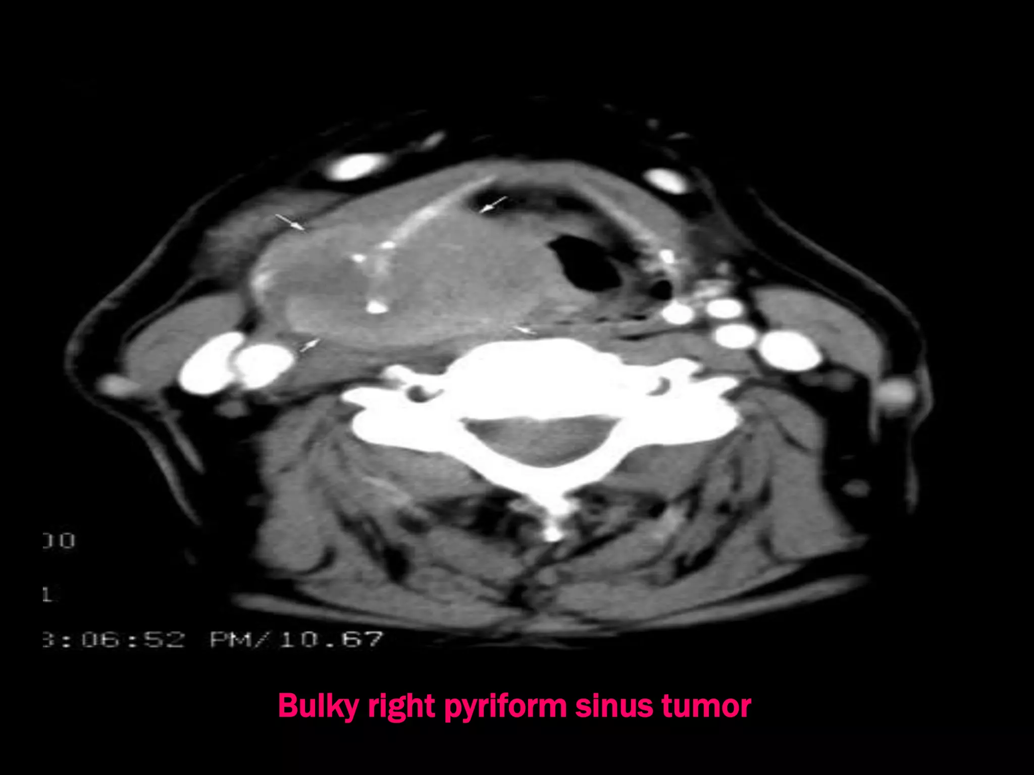 Carcinoma of hypopharynx | PPT