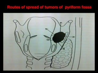 Carcinoma of hypopharynx | PPT