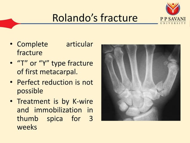 10. Scaphoid fracture, Benett's fracture, Rolando's fracture, Mallet's ...