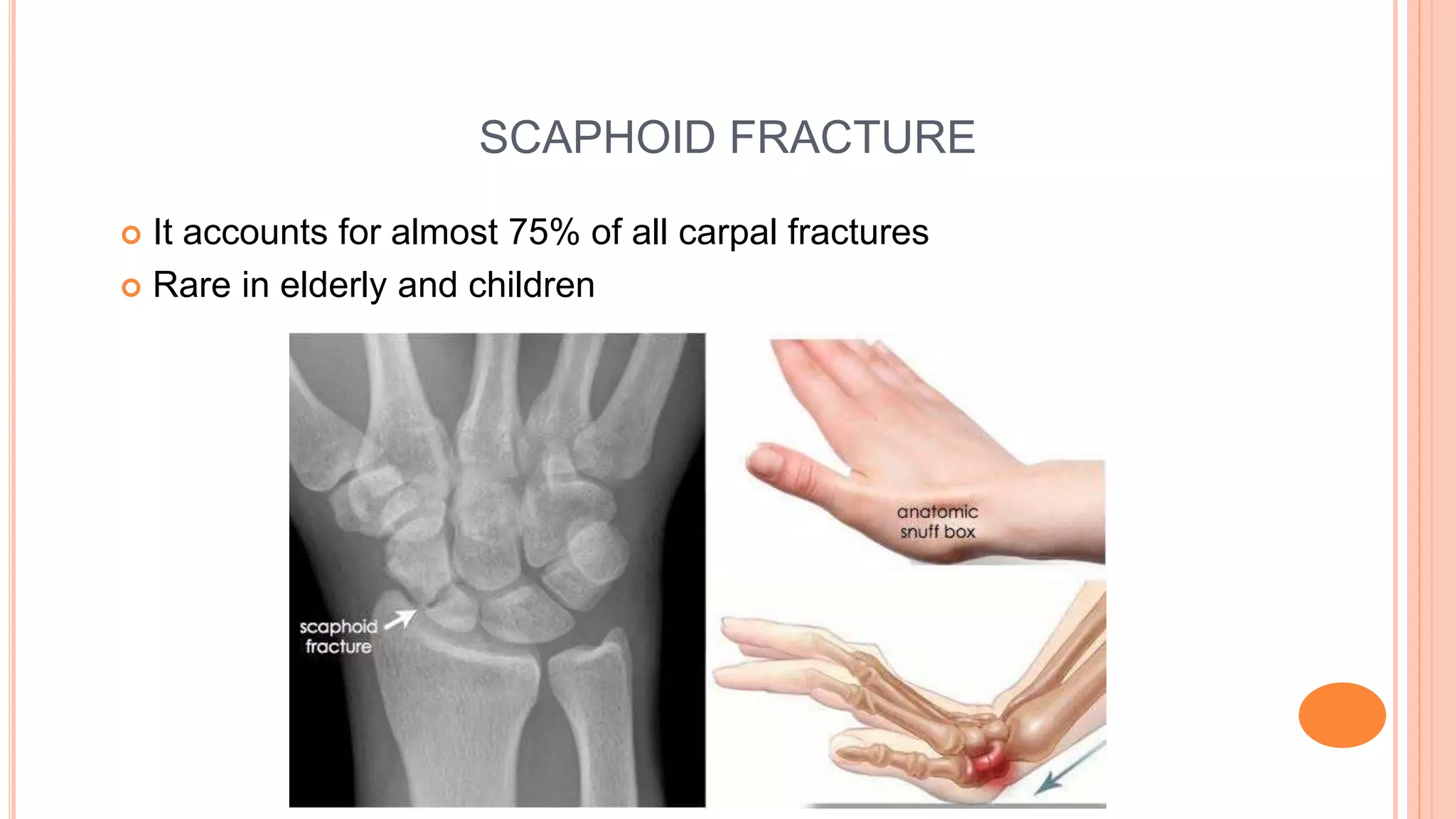 Scaphoid fracture | PPTX