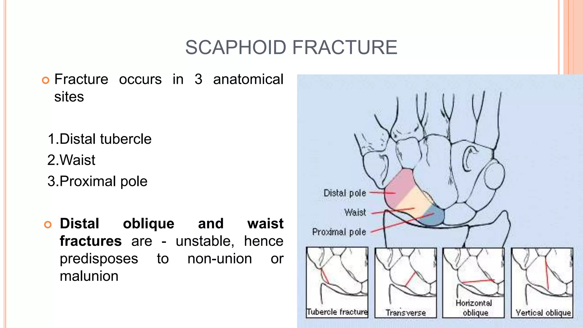 Scaphoid Fracture PPTX