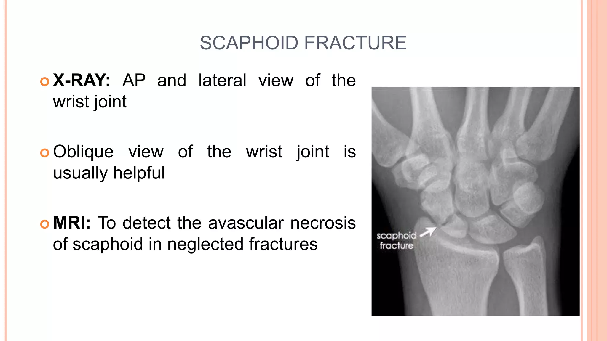 Scaphoid fracture | PPTX