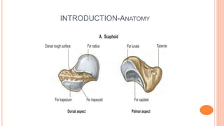 Scaphoid fracture | PPTX