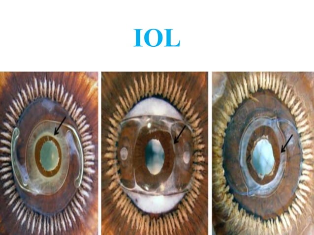 Intraocular lens (IOL)- cataract management | PPT