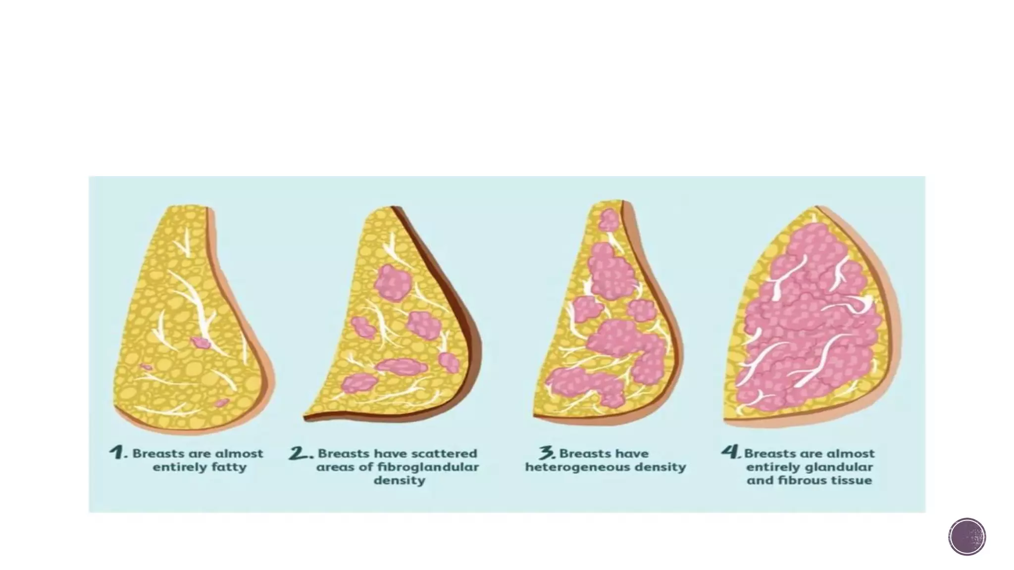 Mammographic density and breast cancer | PPTX