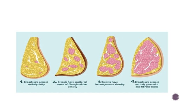 Mammographic density and breast cancer | PPT