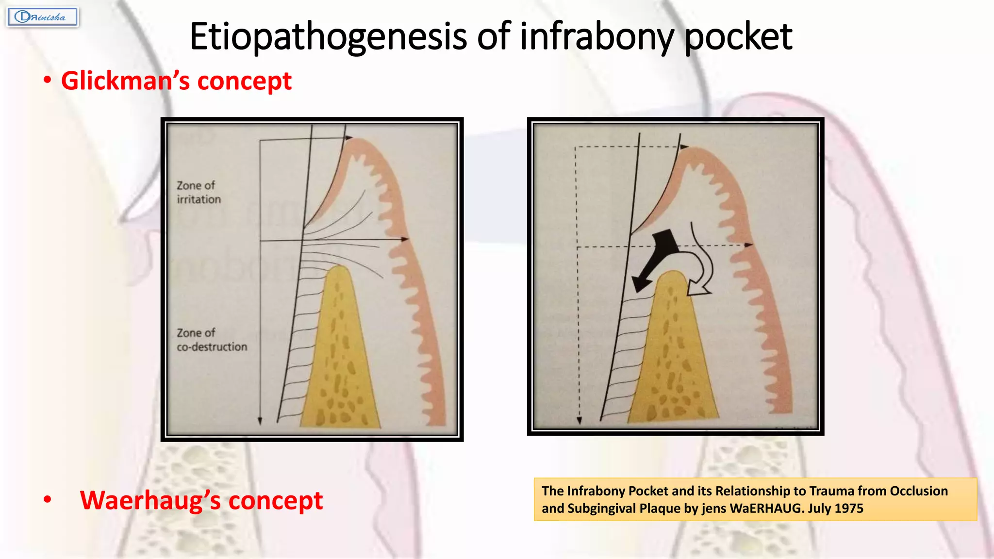 Treatment of Infrabony Pockets.pptx