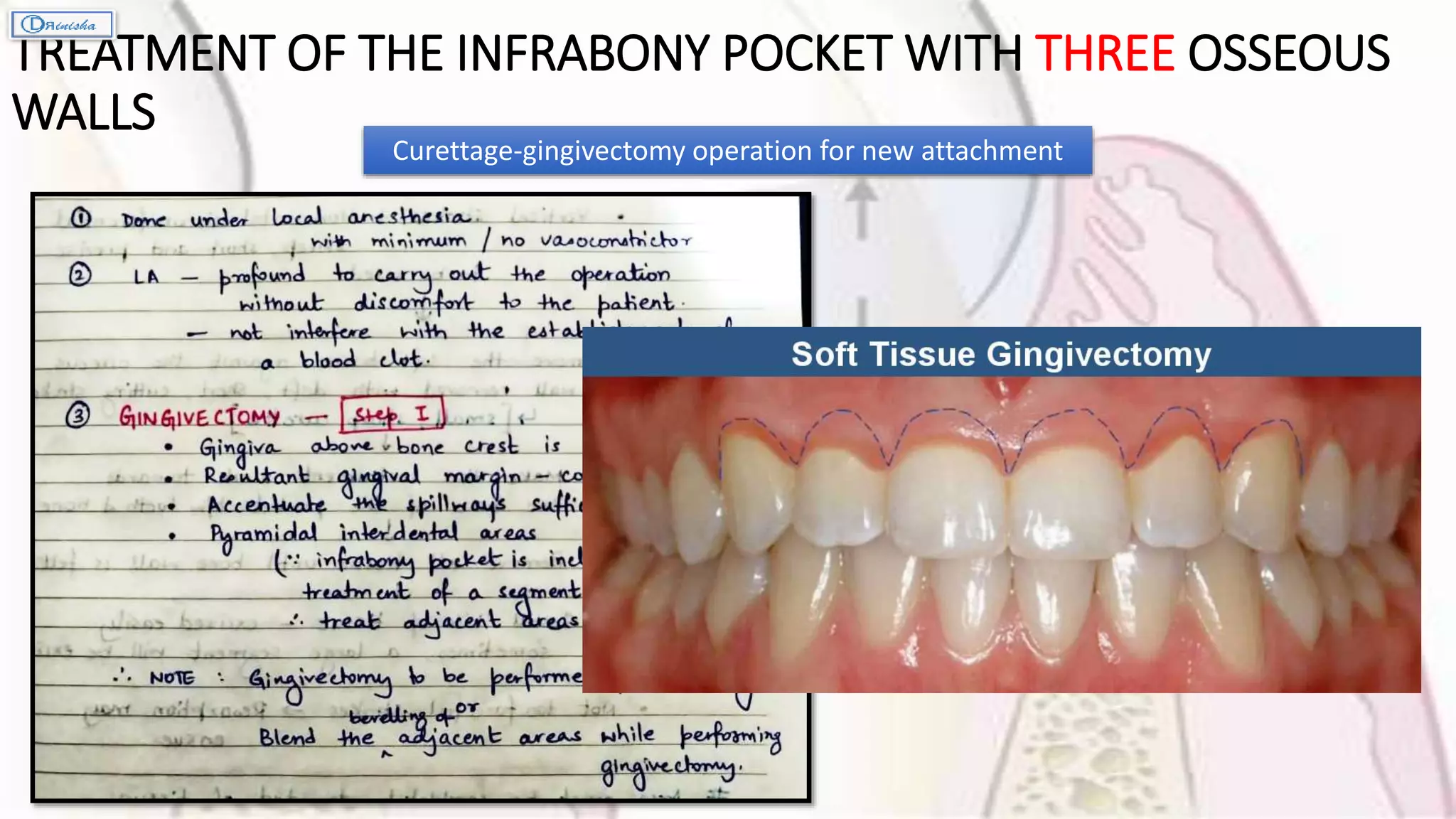 Treatment of Infrabony Pockets.pptx